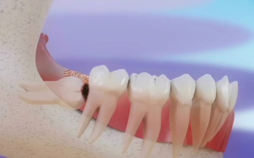 Impacted Tooth Treatment - Dr.Mert AKBAŞ