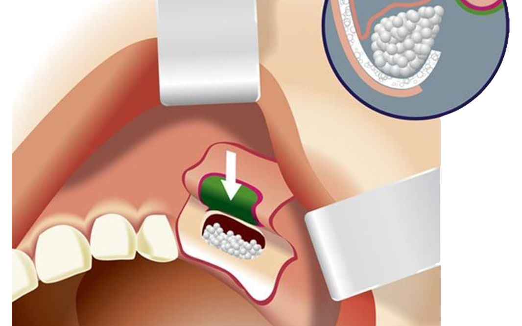 Bone Powder Application - Dr.Mert AKBAŞ