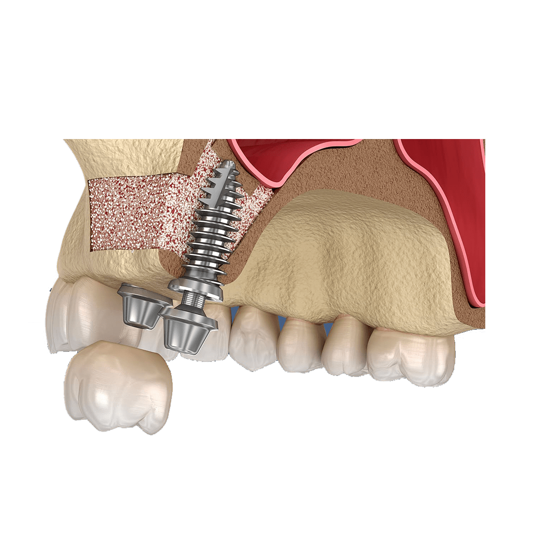Bone Powder Application - Dr.Mert AKBAŞ
